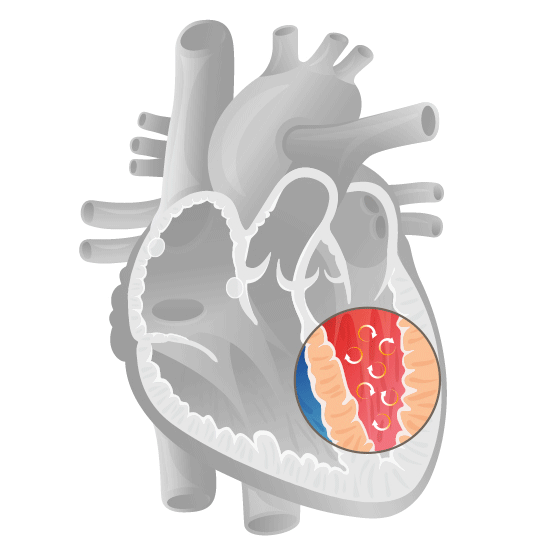 Ventricular Fibrillation Gif