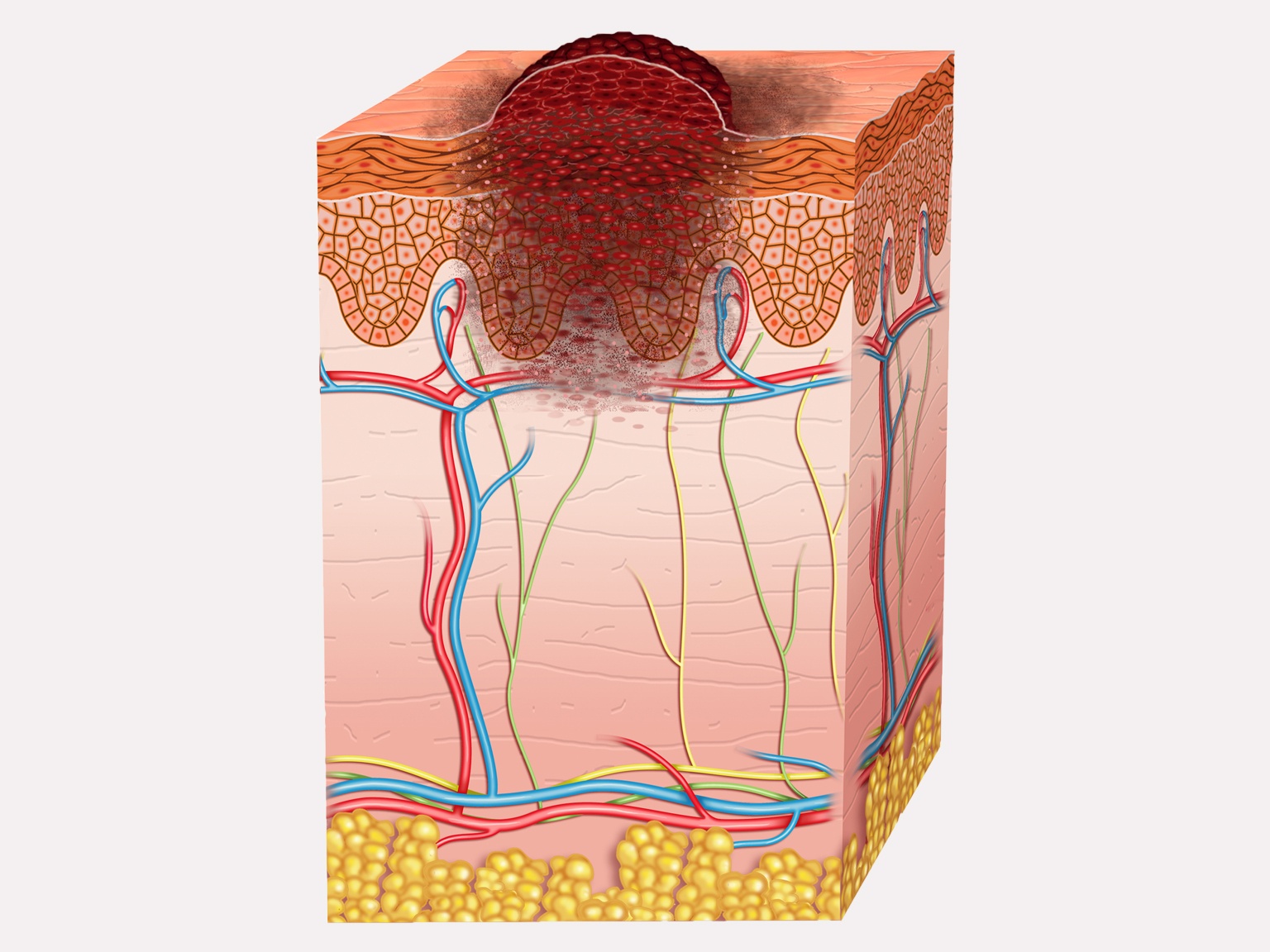 Cancer de la peau – et maintenant? | Hirslanden